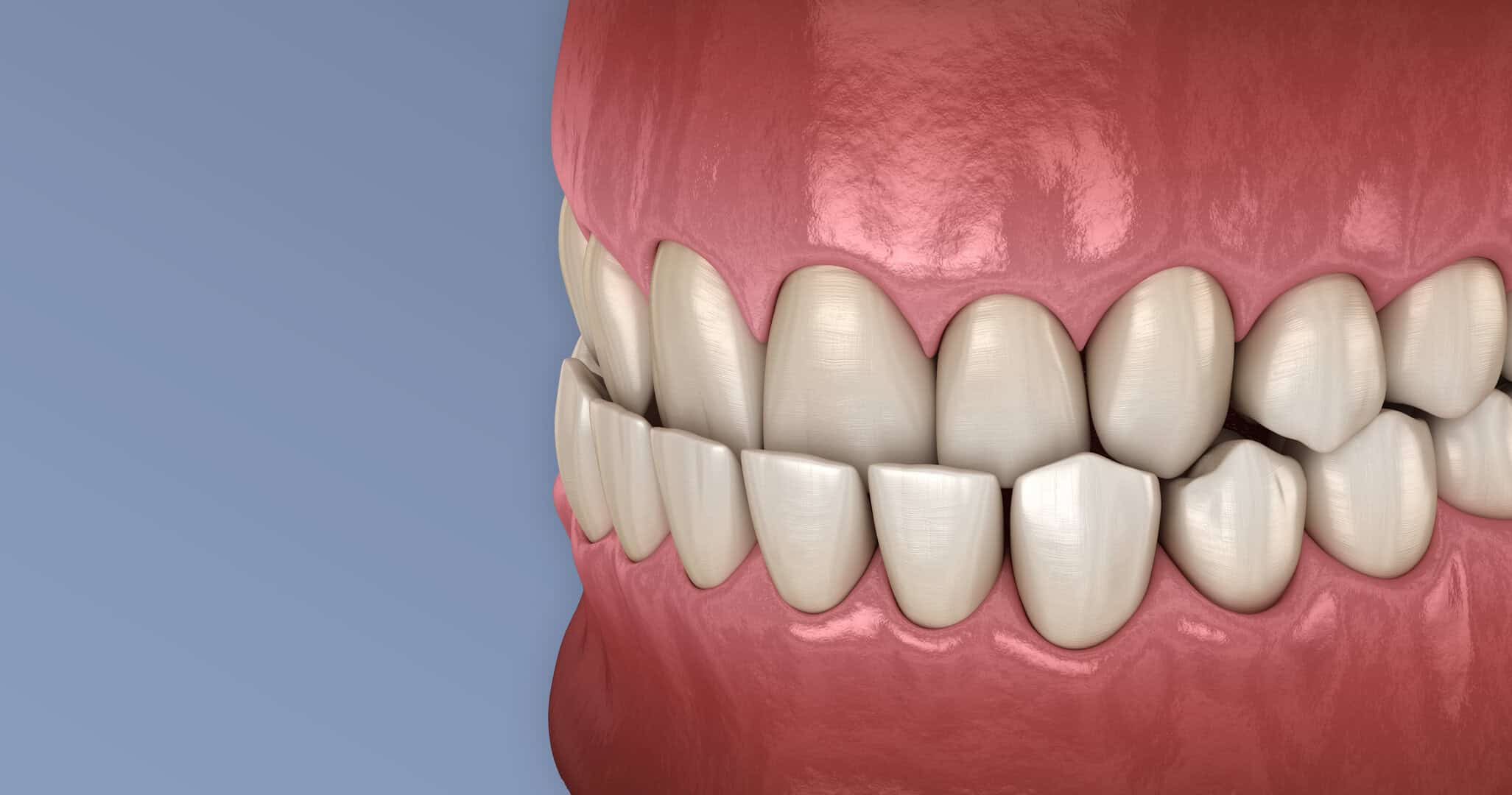 Underbite Correction in San Antonio, TX | Bite Correction